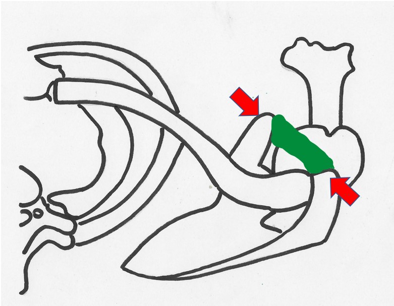 Lesión osteopática de expansión de los ligamentos coracoides